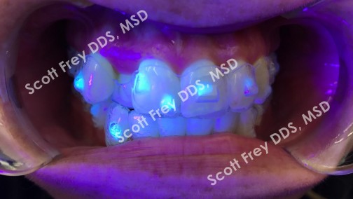 Evaluating Invisalign Tracking & Attachment Flash - The Ortho Cosmos