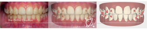 Using Attachments in Clear Aligner Therapy - The Ortho Cosmos