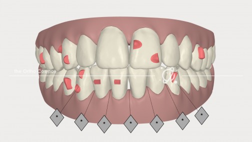 Decoding Invisalign's Optimized Attachment & Optimized Feature ...