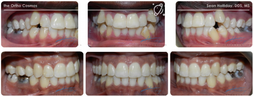 Can We Treat Challenging Malocclusions with Invisalign? - The Ortho Cosmos