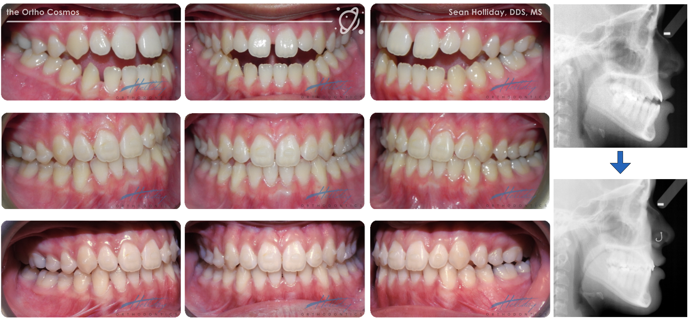 Can We Treat Challenging Malocclusions With Invisalign The Ortho Cosmos Can We Treat Challenging Malocclusions With Invisalign The Ortho Cosmos