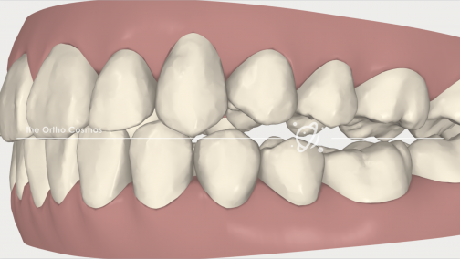 Posterior Openbites with Aligners - The Ortho Cosmos