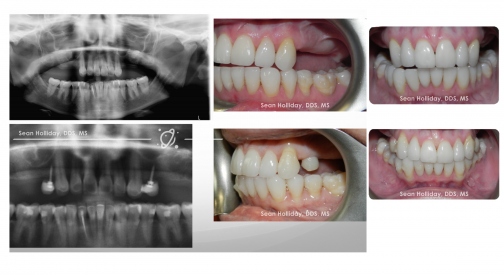 Using TAD’s with Aligners - The Ortho Cosmos