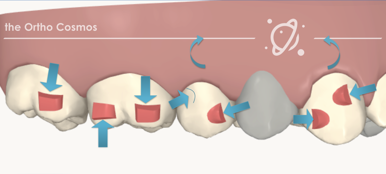 Extraction Treatment with Invisalign - The Ortho Cosmos Extraction Treatment with Invisalign - The Ortho Cosmos
