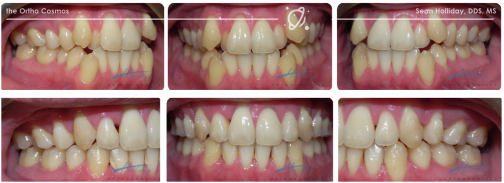 Extraction Treatment with Invisalign - The Ortho Cosmos
