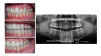 Using TAD’s with Aligners - The Ortho Cosmos