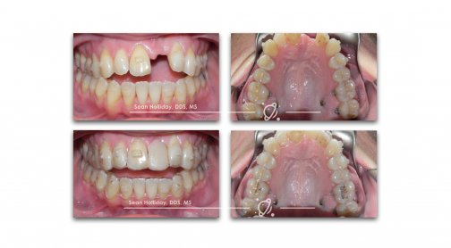 Using TAD’s with Aligners - The Ortho Cosmos
