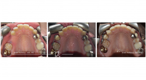 Using TAD’s with Aligners - The Ortho Cosmos
