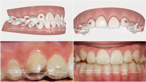 Erupting Dentition in Aligner Therapy - The Ortho Cosmos